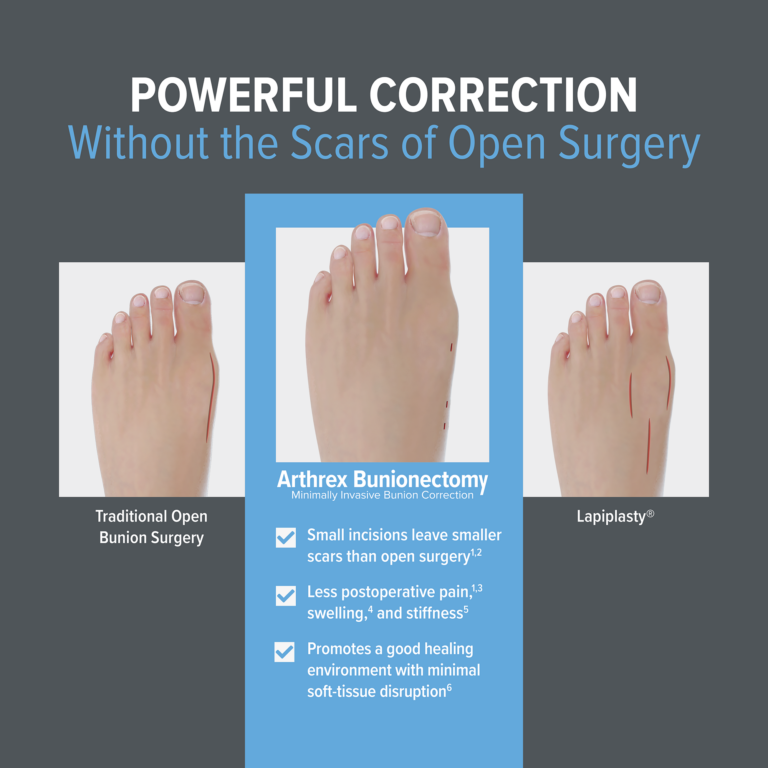 Minimal Incision Bunion Correction - Foot & Ankle Associates