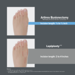 Minimal Incision Bunion Correction - Foot & Ankle Associates